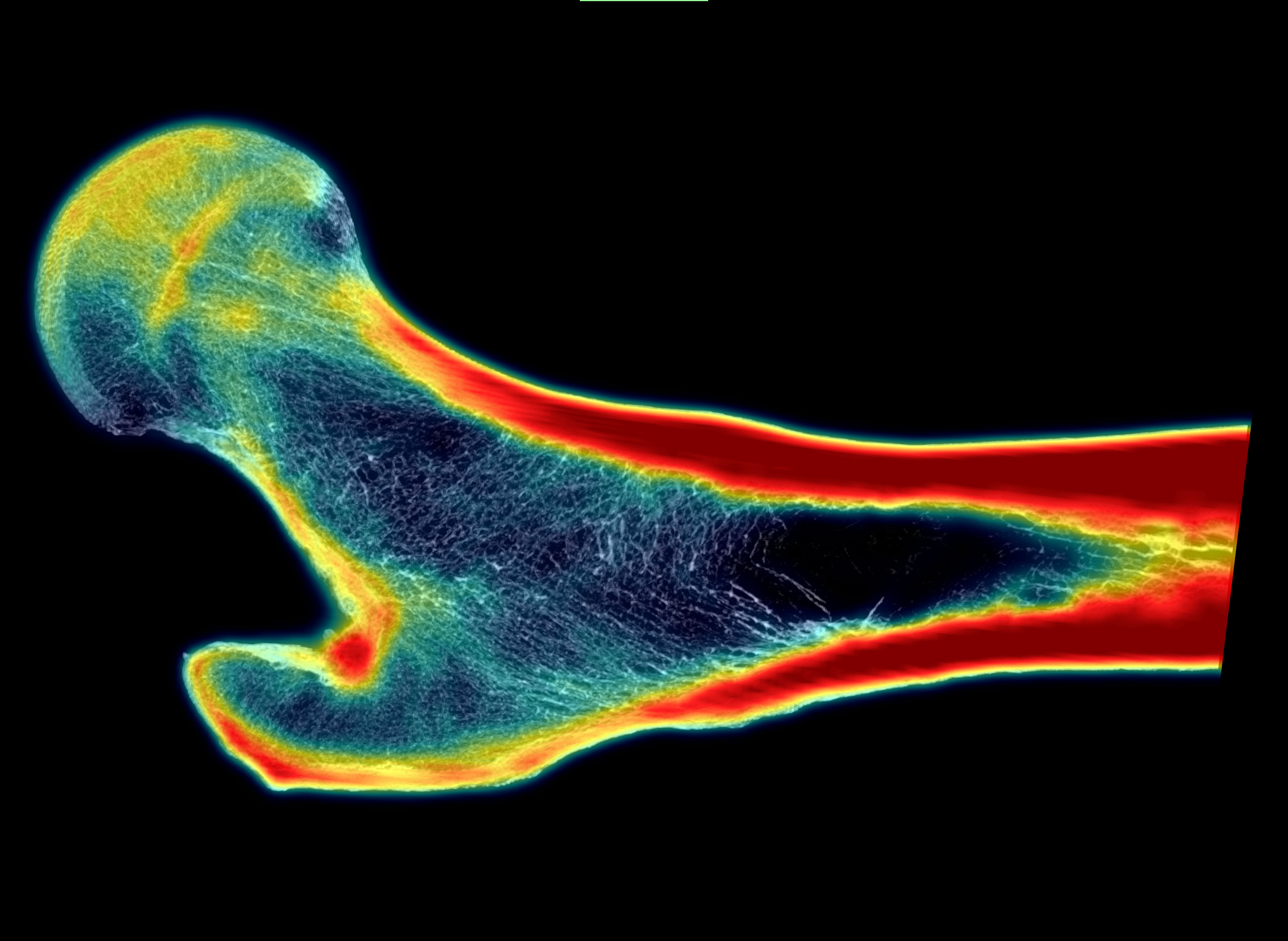 SwRI develops tool to predict osteoporotic fracture risk | Southwest ...